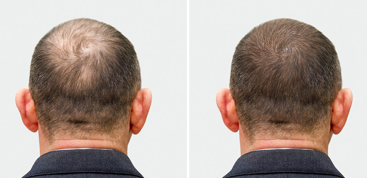 Hair Transplant Turkey Package Haista Clinic