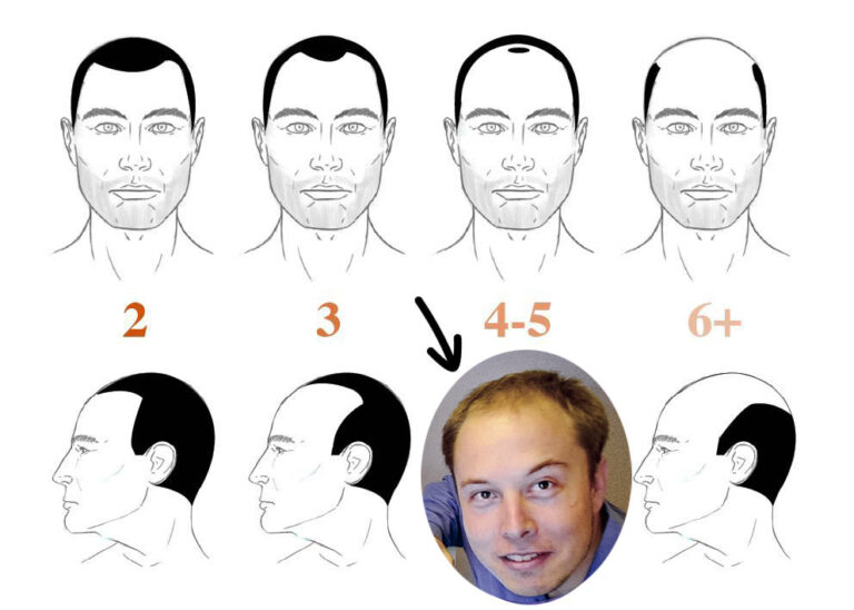 Elon Musk Remarkable Hair Transplant Transformation