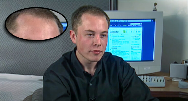 Elon Musk Remarkable Hair Transplant Transformation