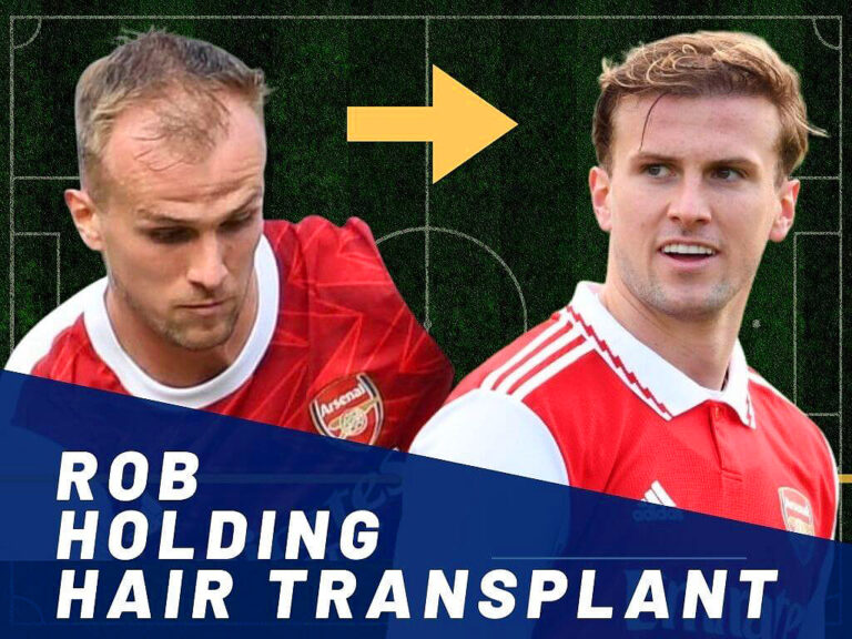 Rob Holding's Remarkable Hair Transplant Transformation - Haista Clinic