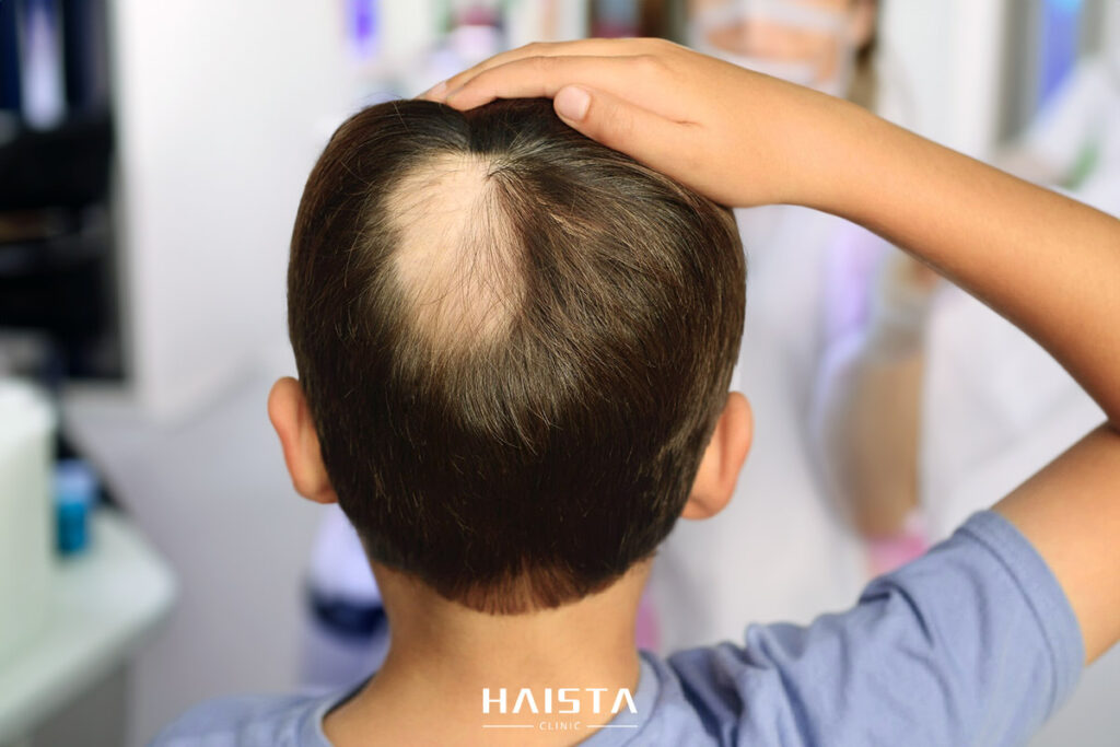 What is Alopecia Areata - Haista Clinic